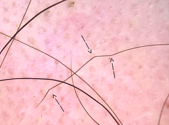 Elbow Hairs in Alopecia Areata — Donovan Hair Clinic