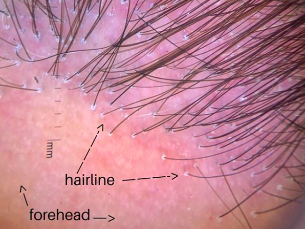 Frontal Fibrosing Alopecia and Rosacea: What is the link? Who is ...