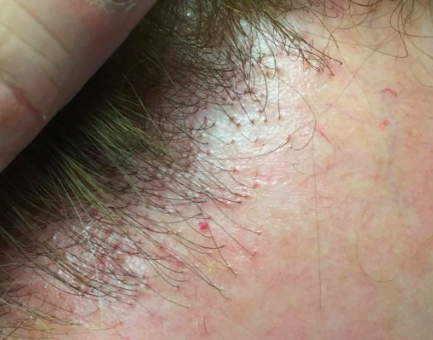 Can one see scaling arounds hairs in LPP/FFA without trichoscopy ...