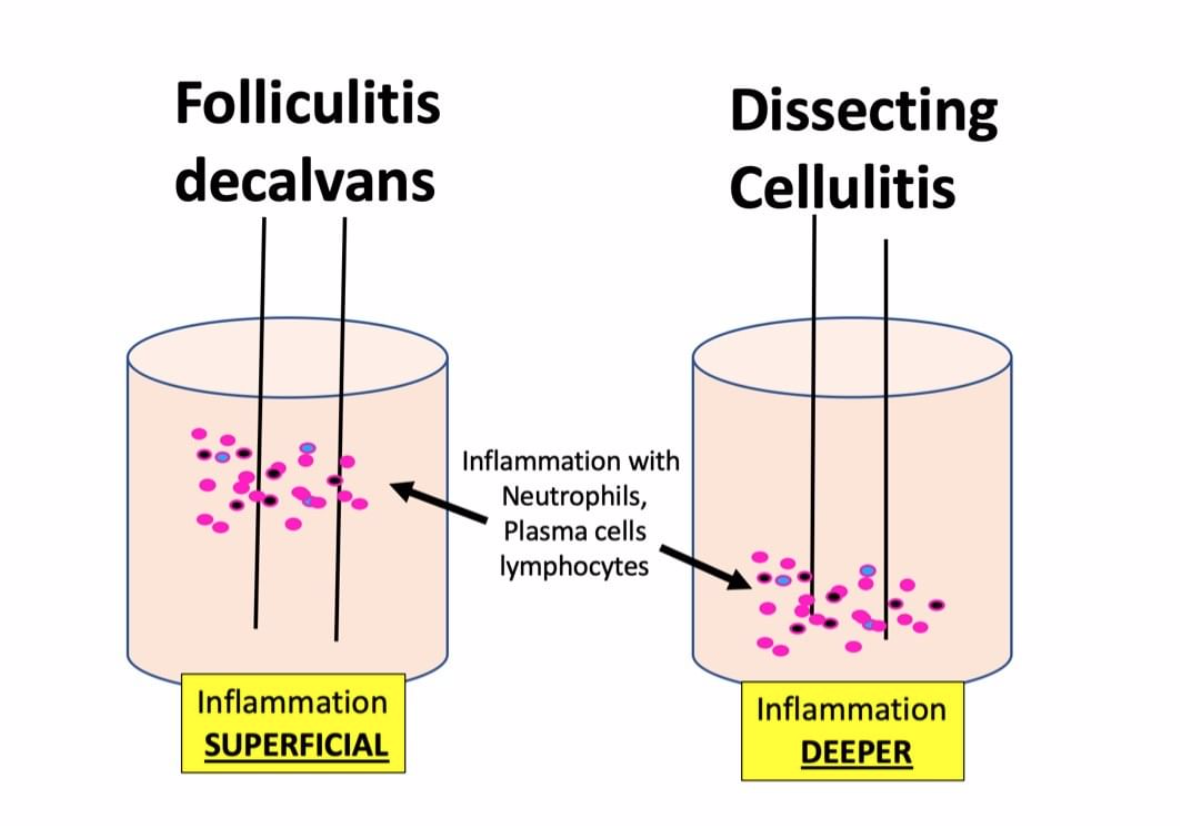 A Closer Look at the Location of Inflammation in Folliculitis Decalvans ...