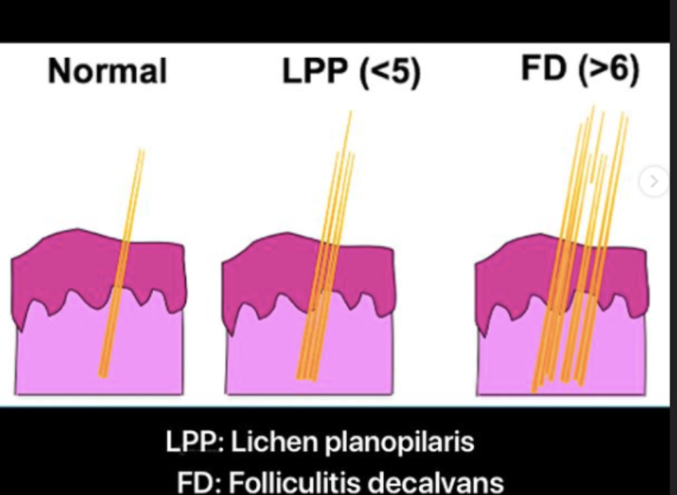 Challenge Case of Compound Follicles - Final Diagnosis Lichen ...