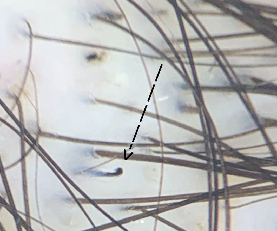 Coiled and Hook Hairs in Trichotillomania — Donovan Hair Clinic