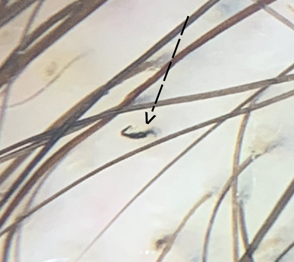 Coiled and Hook Hairs in Trichotillomania — Donovan Hair Clinic