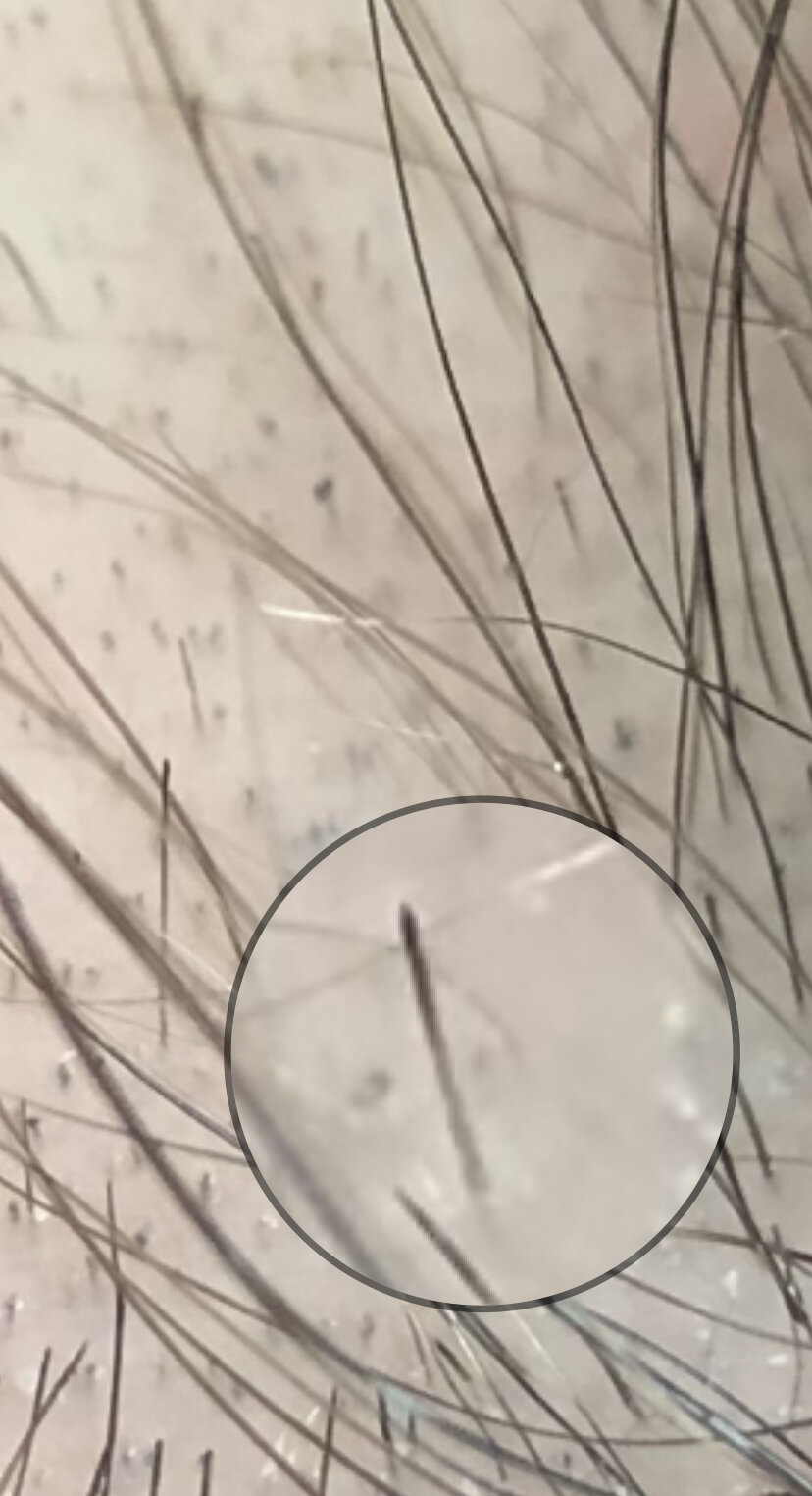 Trichotillomania — QUESTION OF THE WEEK — Donovan Hair Clinic