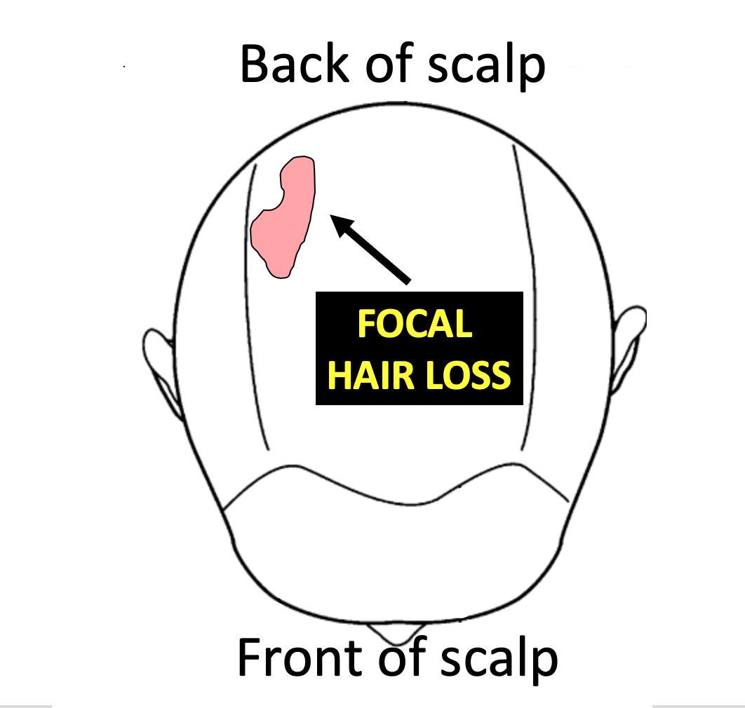 What cancers metastasize to the scalp? — Donovan Hair Clinic