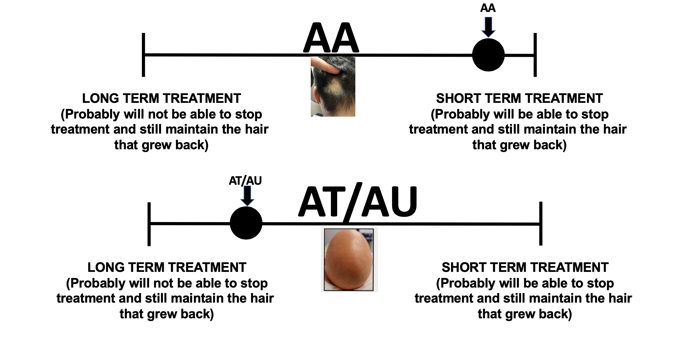 Alopecia Totalis and Alopecia Universalis: How long will I be on ...