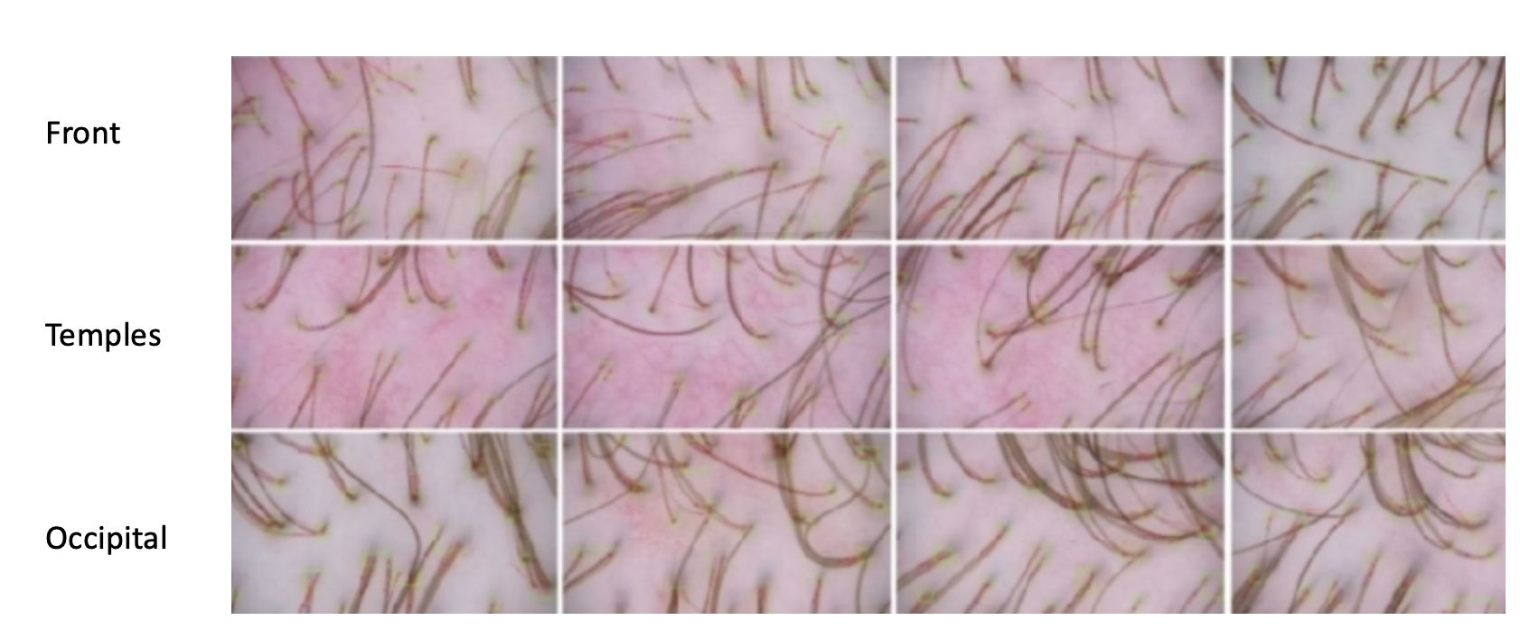 What's the reason for my hair loss? What does my trichoscopy show ...