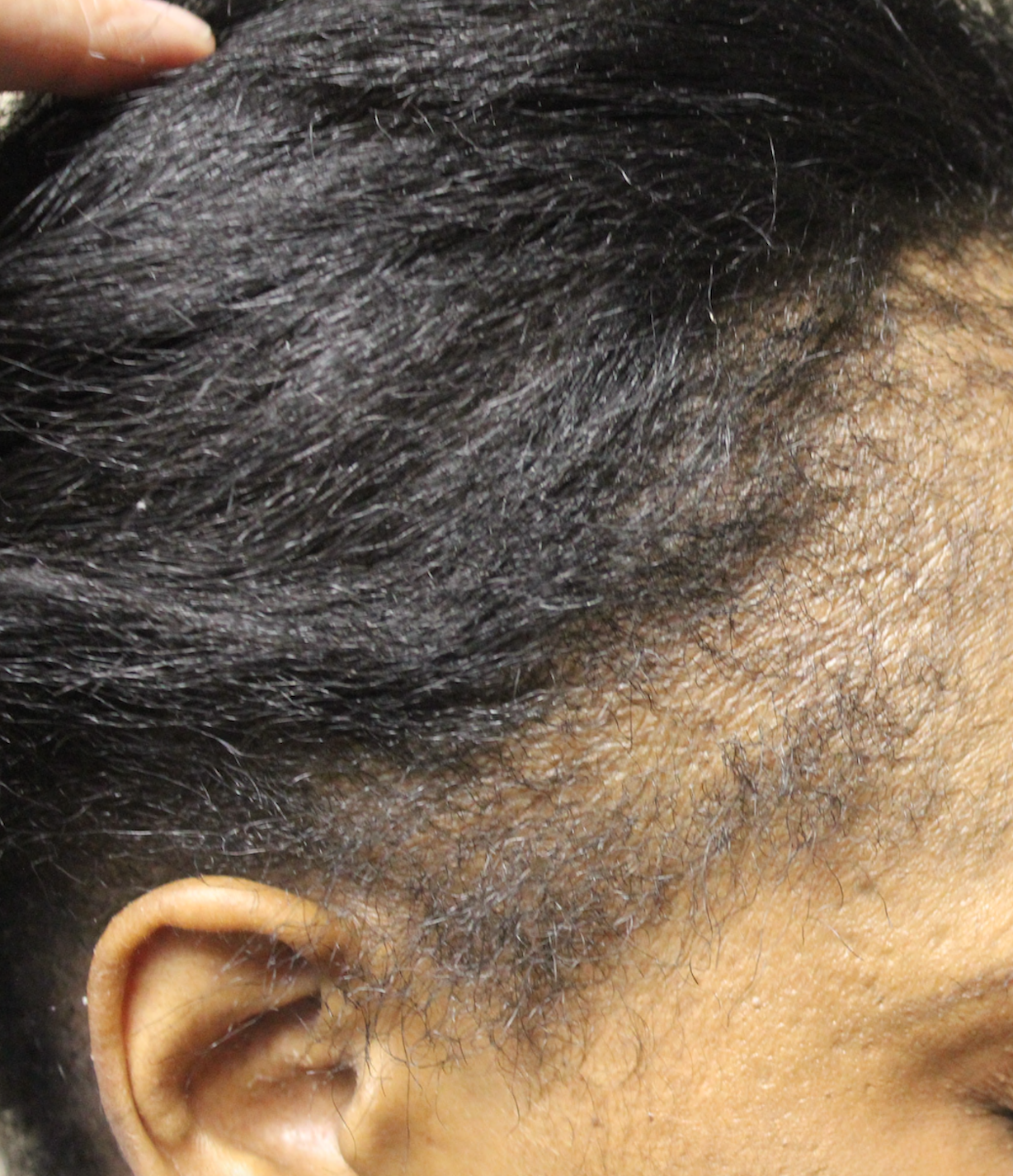 Frontal Hair Line — Dr. Donovan's Hair Loss Articles (2011-2021 ...