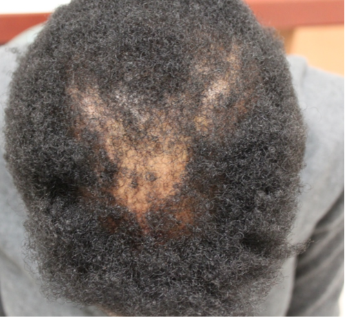 CCCA — QUESTION OF THE WEEK — Donovan Hair Clinic