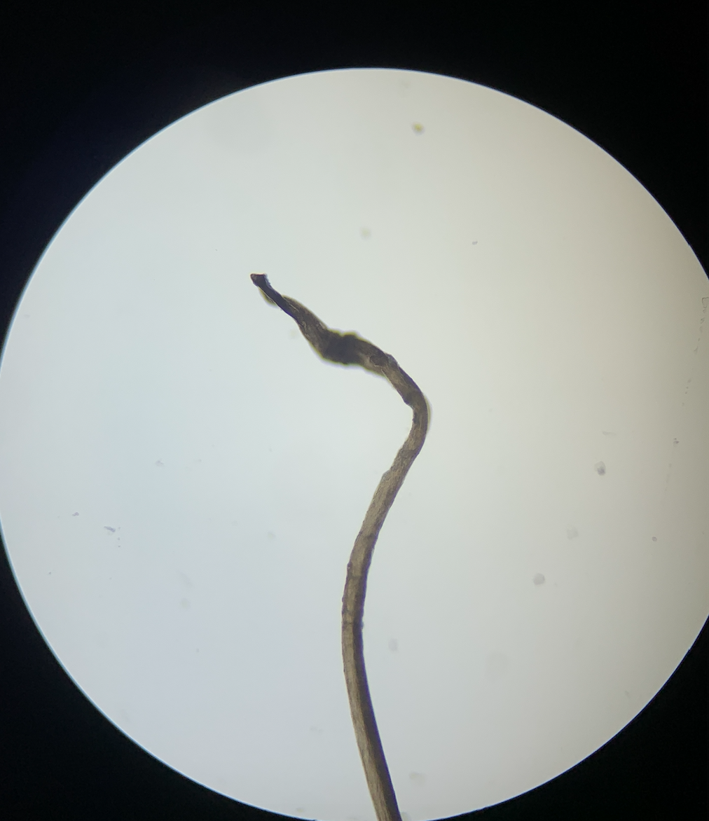 Loose Anagen Hair Syndrome. — Donovan Hair Clinic