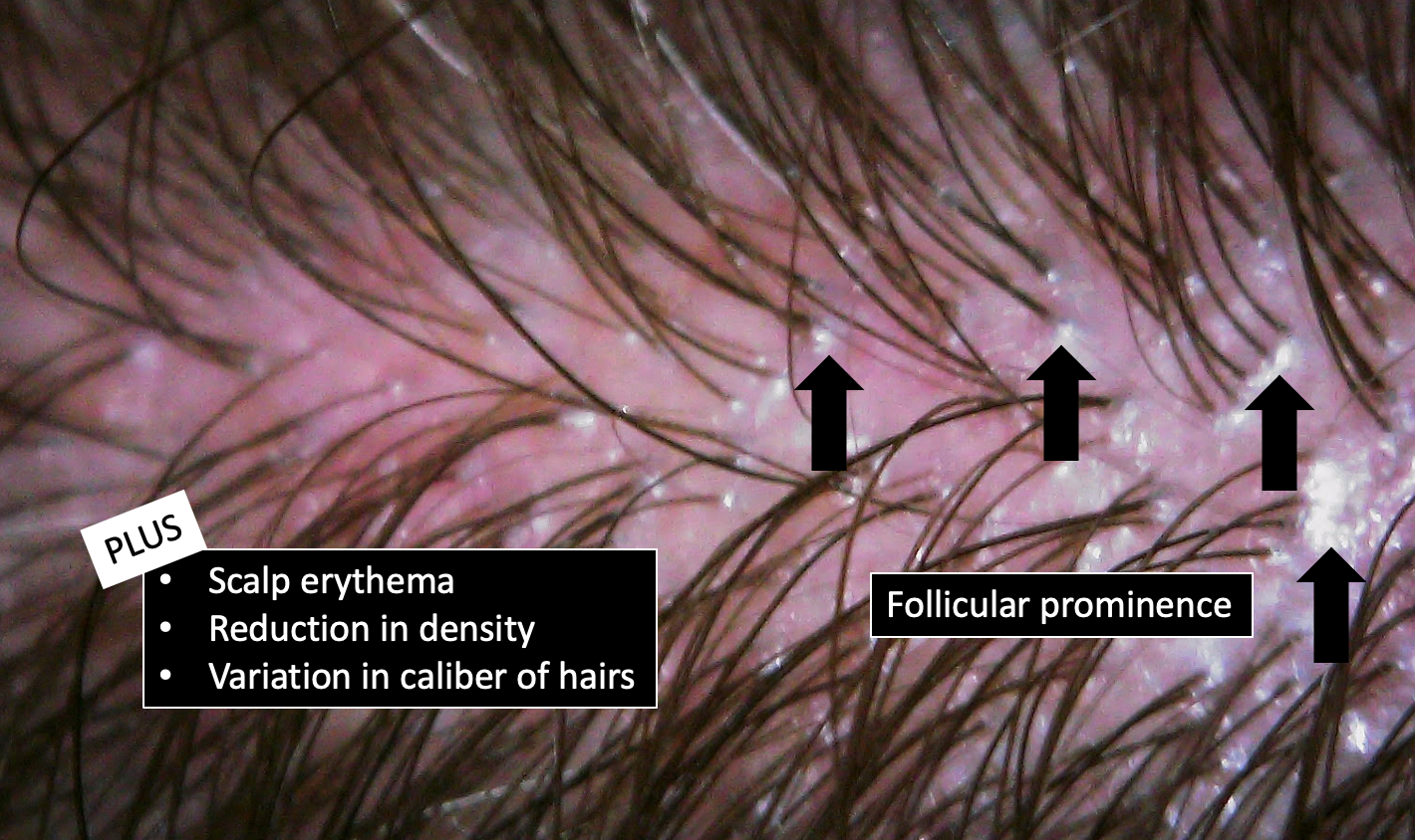 Biopsy — QUESTION OF THE WEEK — Donovan Hair Clinic