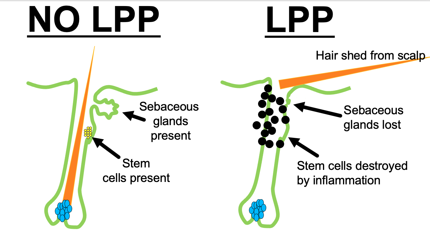 Biopsy — QUESTION OF THE WEEK — Donovan Hair Clinic