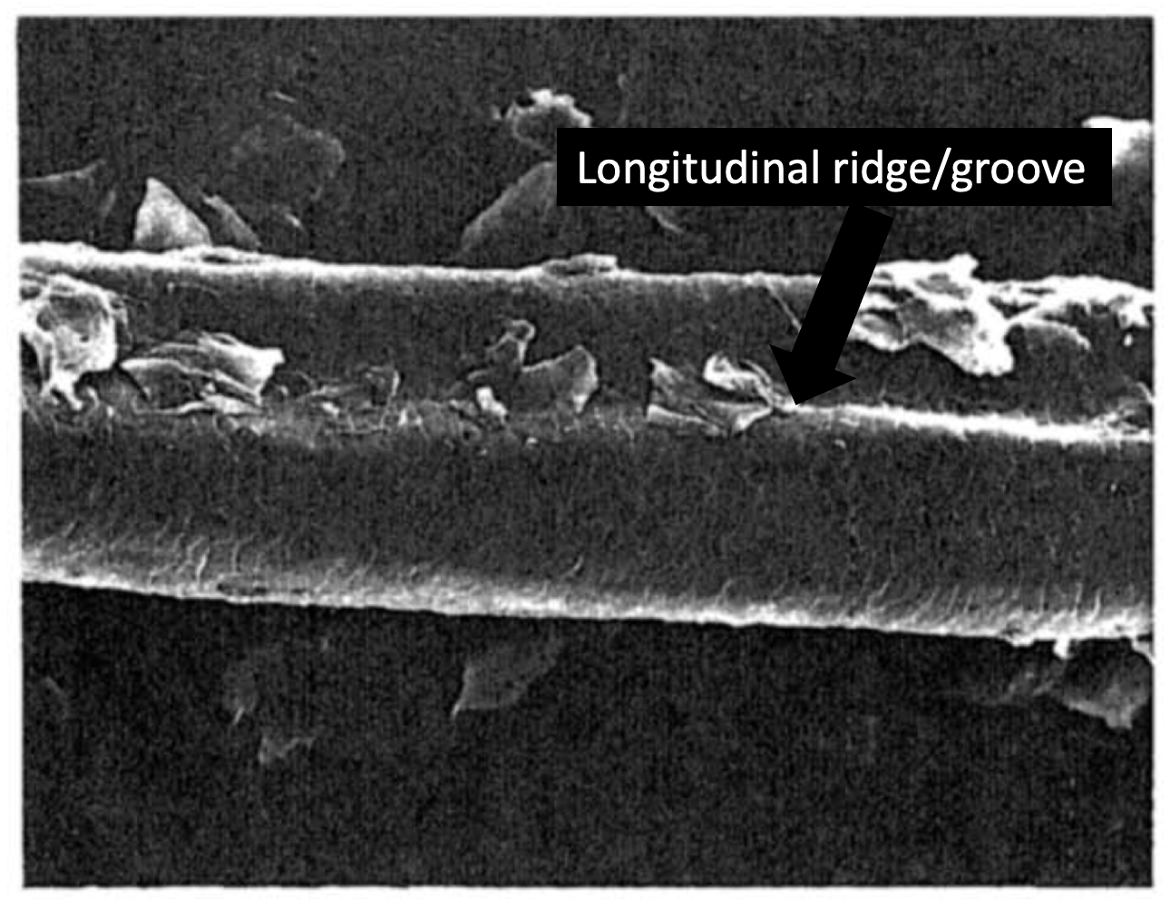 The Uncombable Hair Syndrome — Donovan Hair Clinic