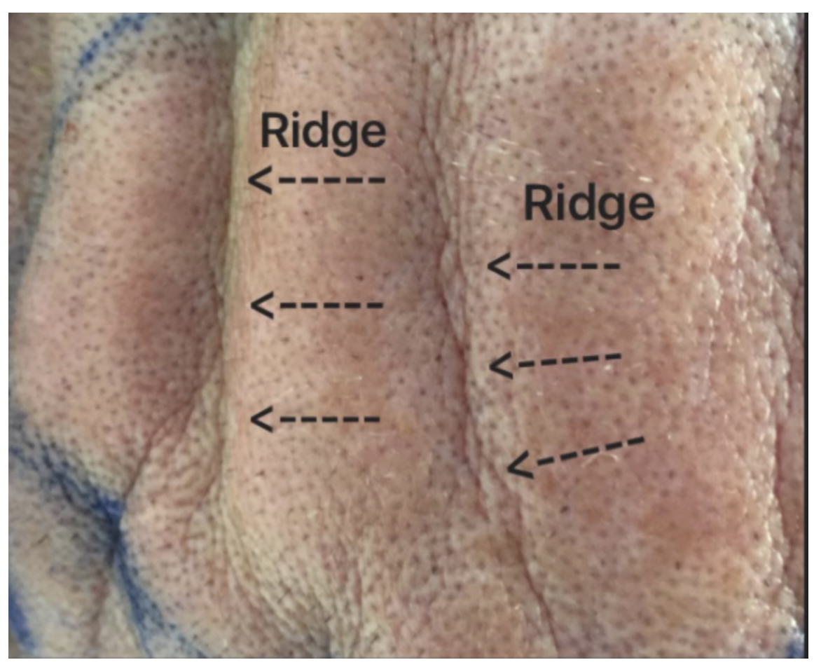 Diagnosis and Treatment of Cutis Verticis Gyrata (CVG) — Donovan Hair ...