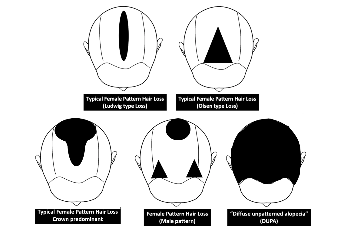 Does FPHL cause hair loss on the sides? — Donovan Hair Clinic