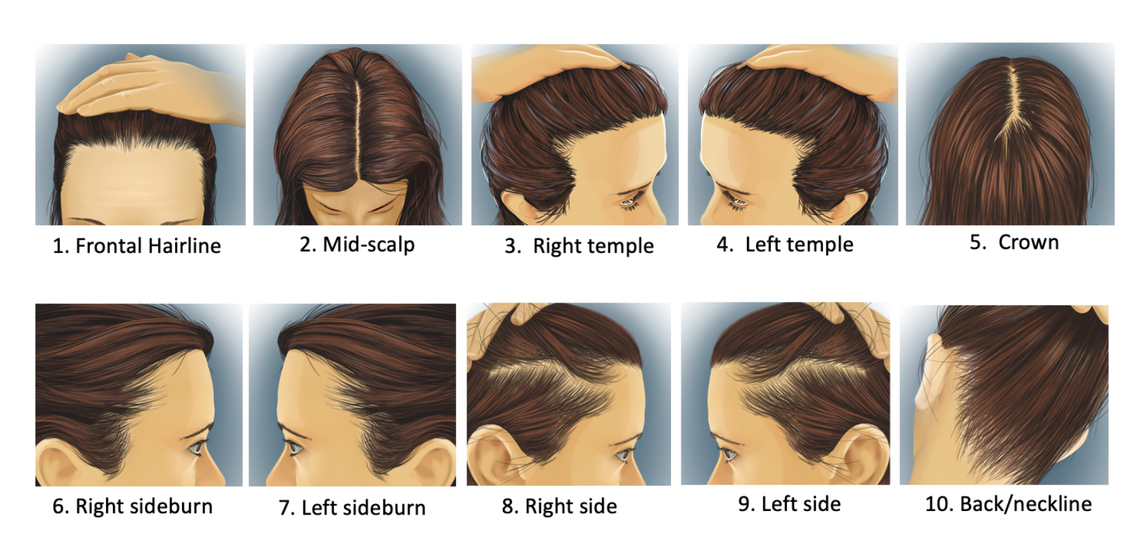 Hair Transplantation for Frontal Fibrosing Alopecia — Donovan Hair Clinic