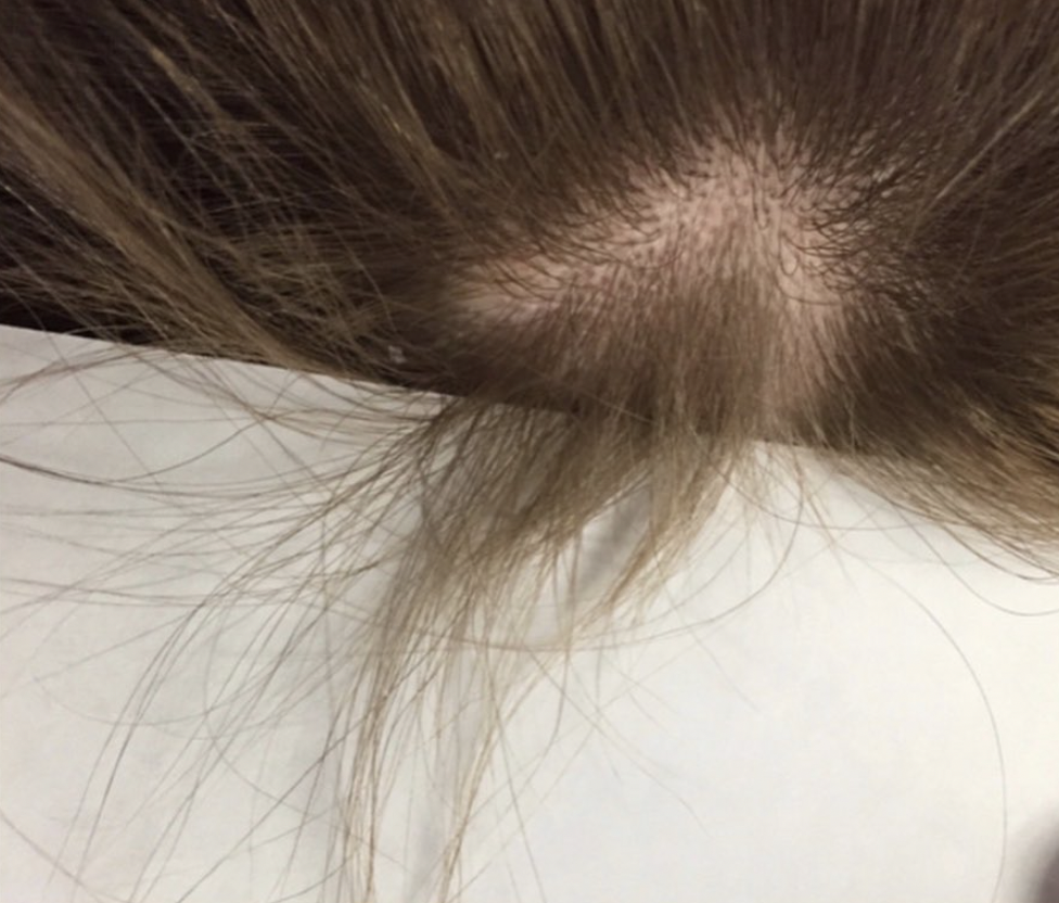 Treatment of "Patchy" Alopecia Areata — Donovan Hair Clinic