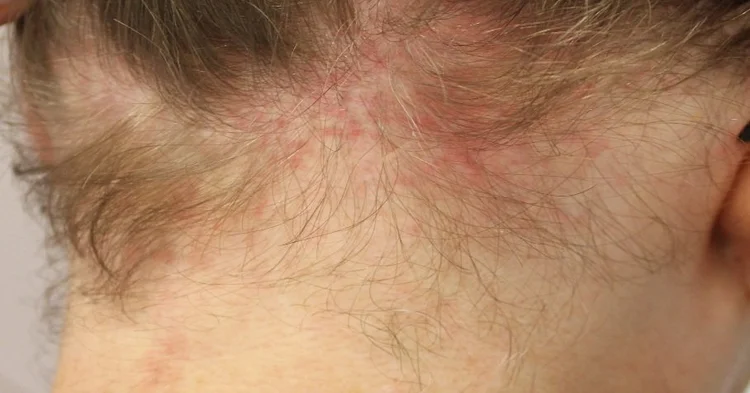 Comparing Ophiasis Alopecia Areata to Occipital Frontal Fibrosing ...