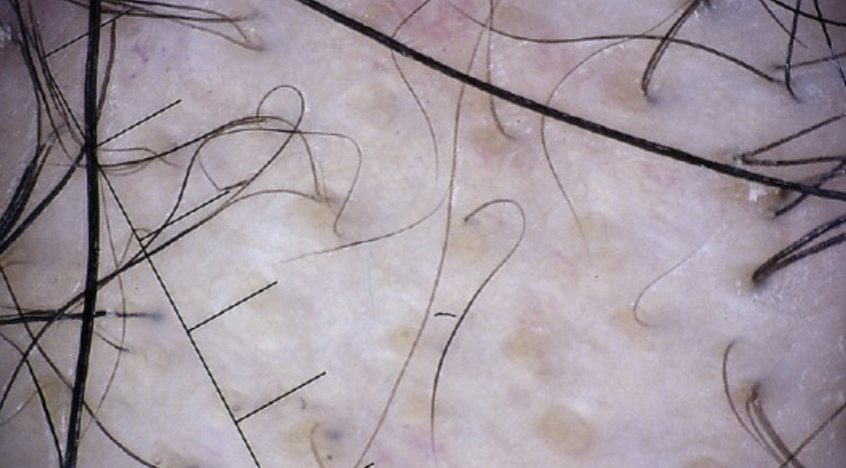 Hair Loss: What's causing my hair loss? — Donovan Hair Clinic