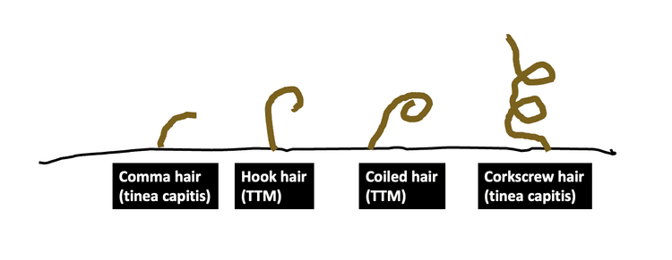 Comma, Hook, Coiled and Corkscrew Hairs by Trichoscopy: What do they ...