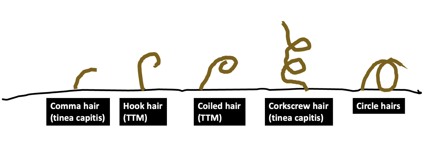 Comma, Hook, Coiled and Corkscrew Hairs by Trichoscopy: What do they ...