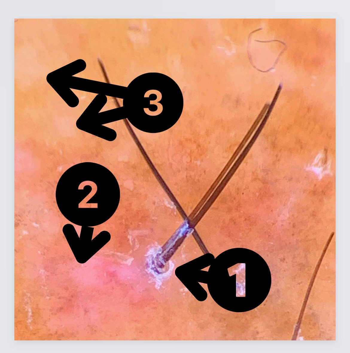 Trichoscopy of Lichen Planopilaris Reveals Steps of the Immune Attack — Donovan Hair Clinic
