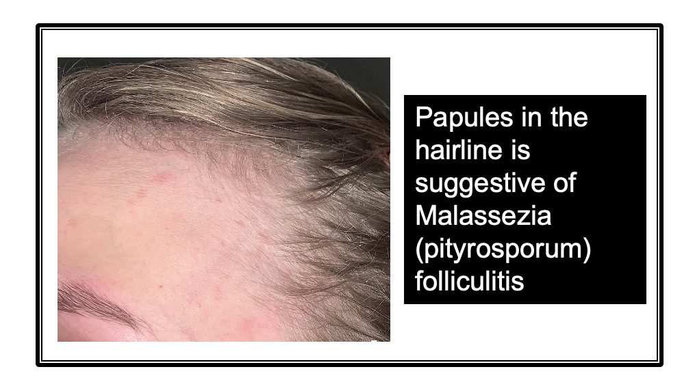 Pityrosporum Folliculitis Scalp