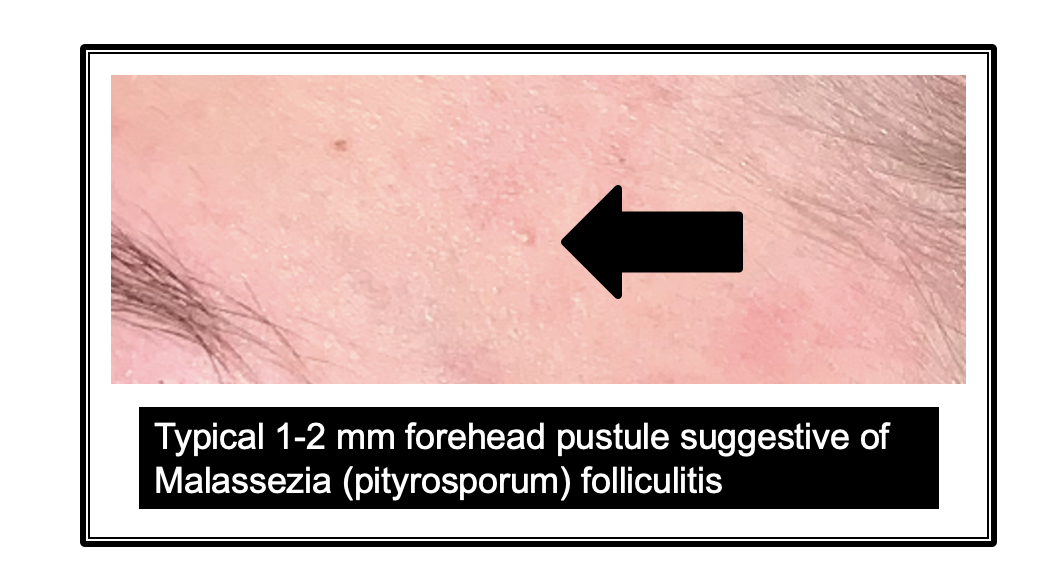 Pityrosporum Folliculitis Histology