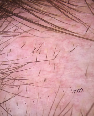 Exclamation Mark Hairs in Alopecia Areata — Donovan Hair Clinic
