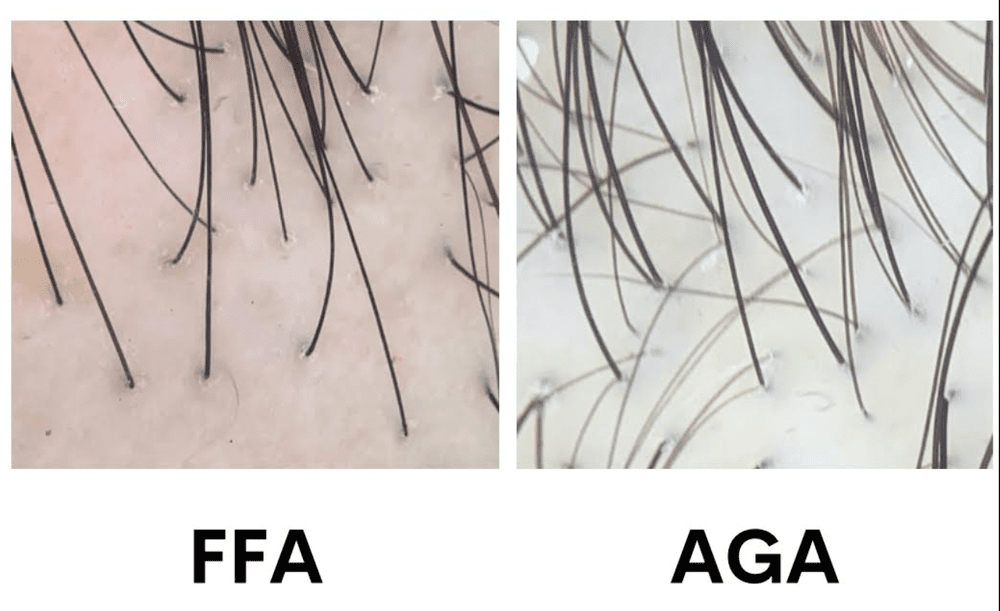 Trichoscopy of Early Frontal Fibrosing ALopecia (FFA) — Donovan Hair Clinic