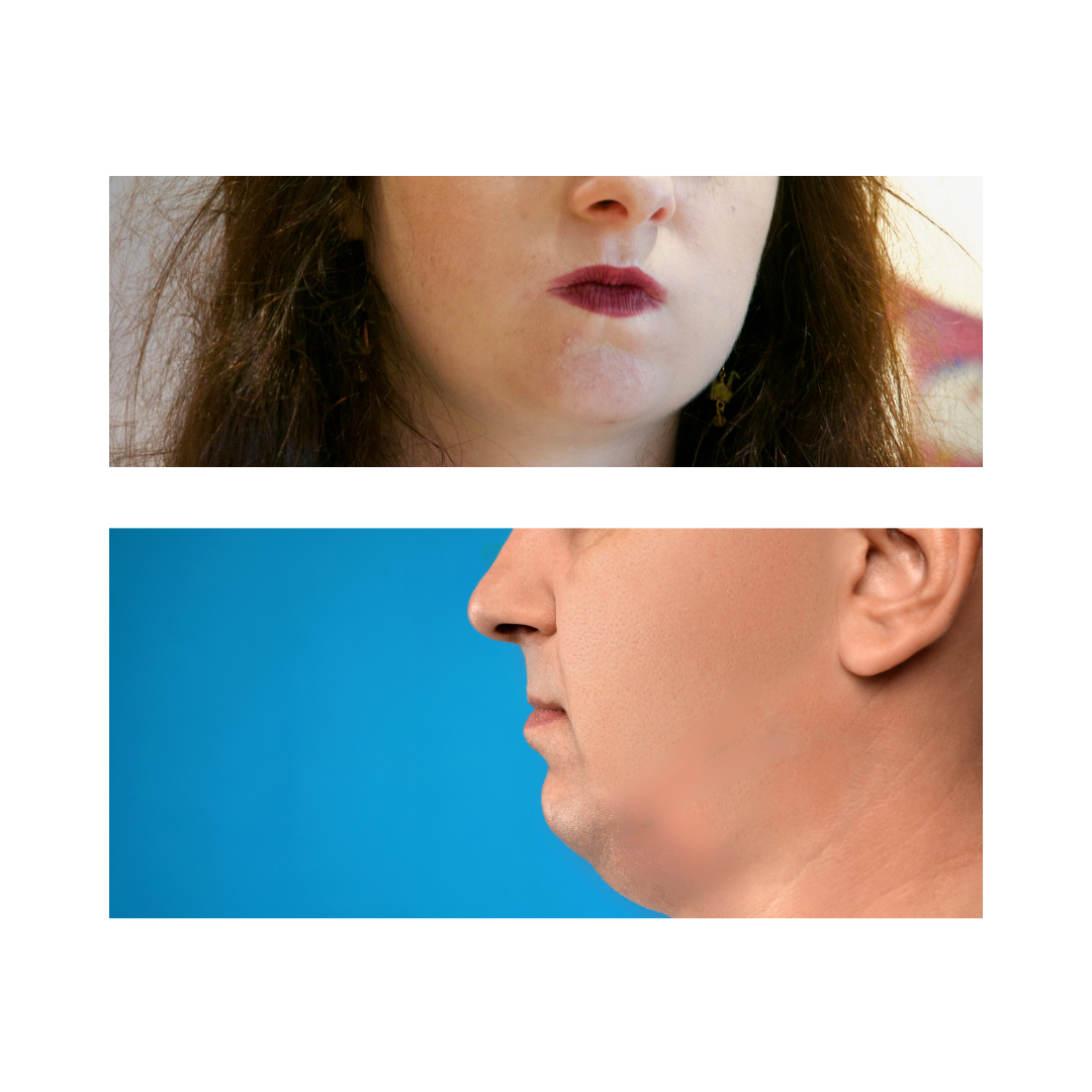 How To Get Rid of My Double Chin? — Scrub Me Skin Care Studio ...
