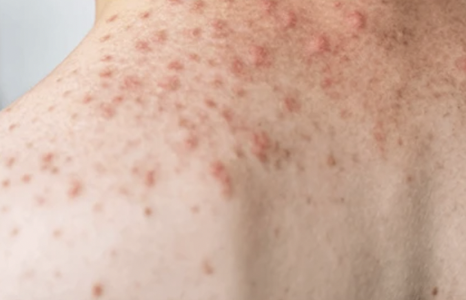 Textured Skin on the Body: Causes, Types, and How to Treat It — scrub ...