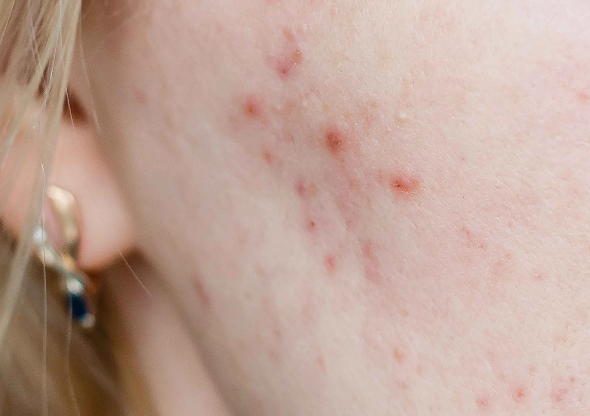 What Does My Acne Mean Moody Sisters Skincare