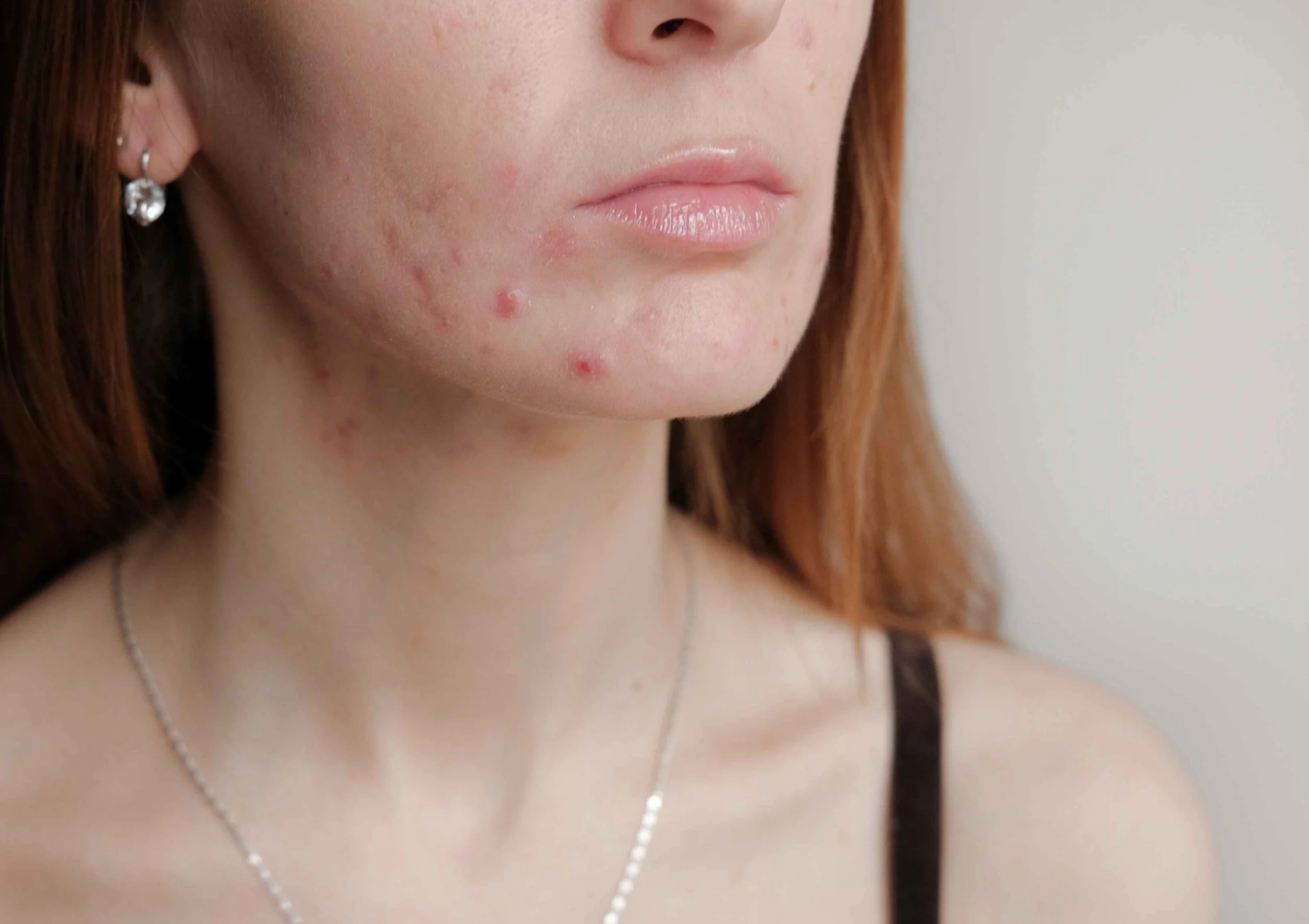 Best Natural Products for Acne — Moody Sisters Skincare