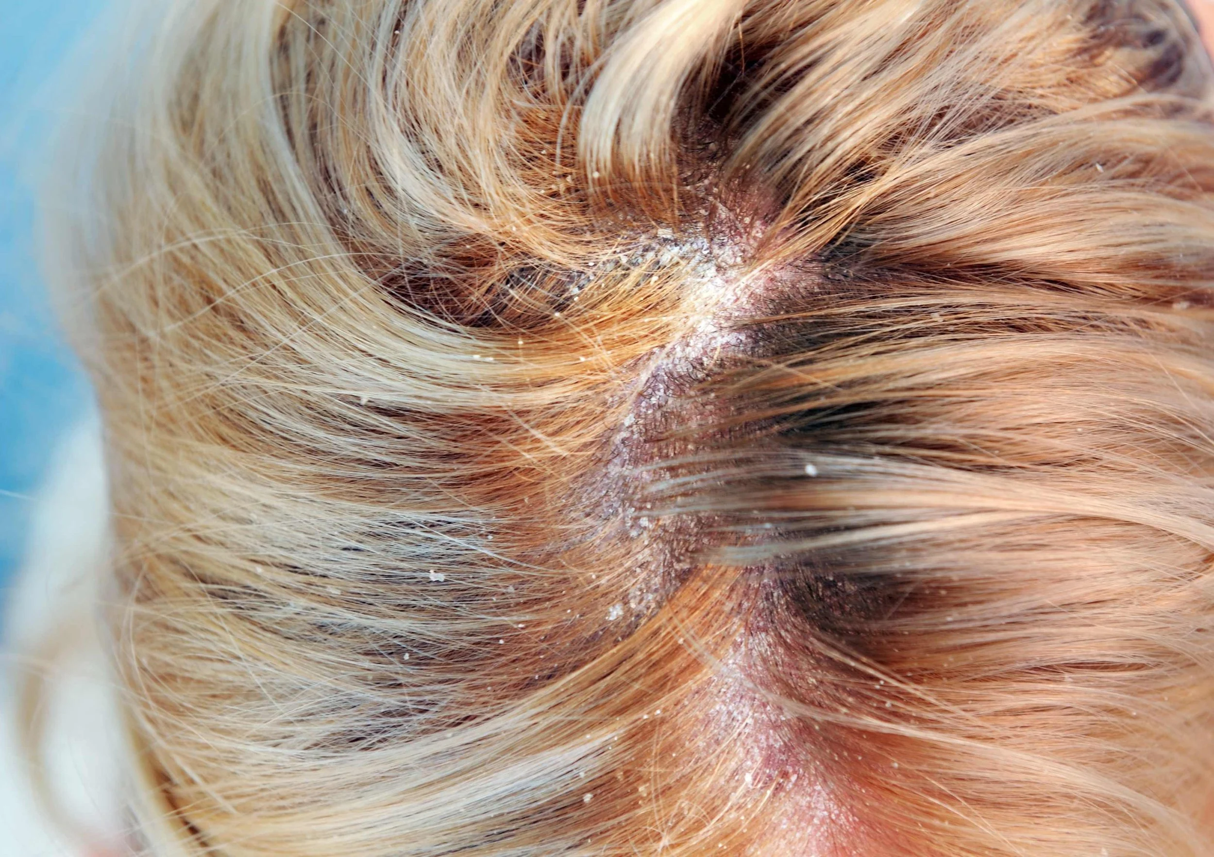 Why Do I Have Dry Patches of Skin on the Face and Body? — Moody Sisters ...