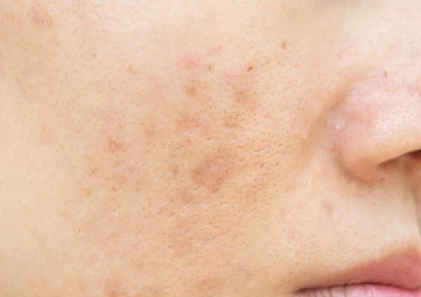 What Are Age Spots — Moody Sisters Skincare