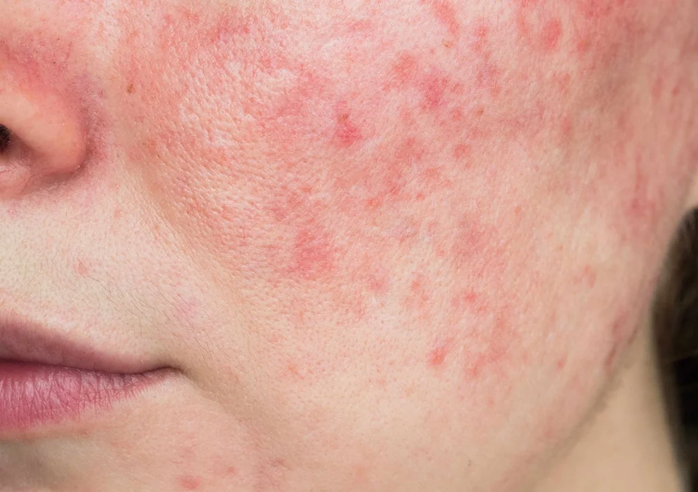 Why is my skin red? — Moody Sisters Skincare