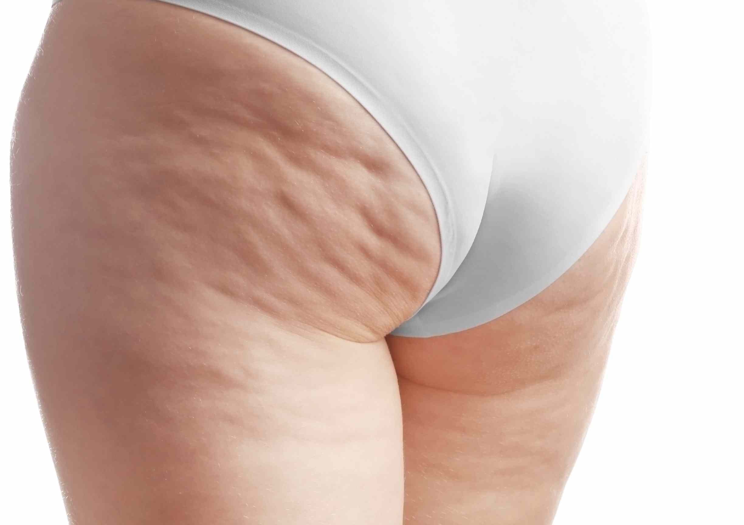 Cottage Cheese Legs
