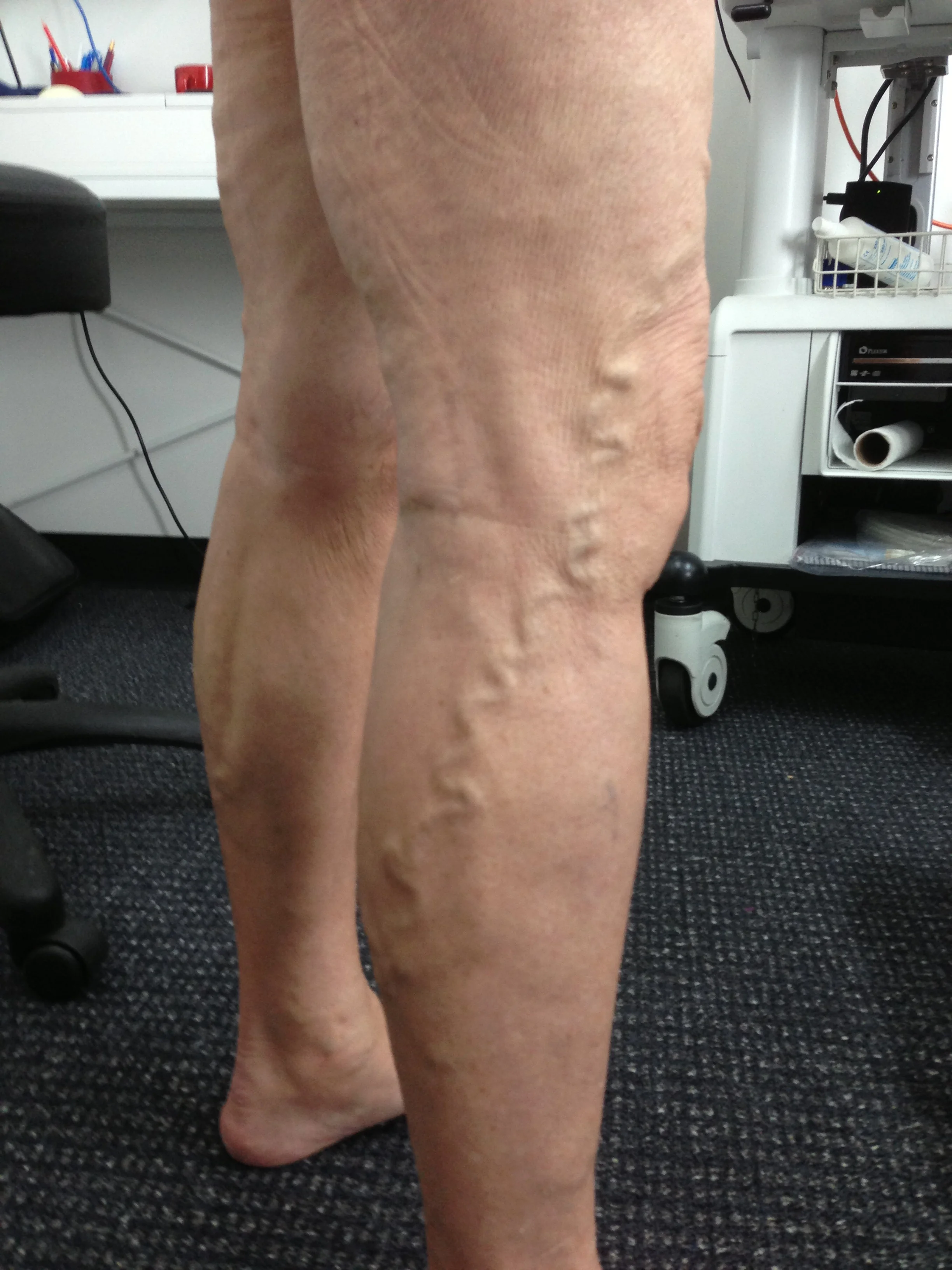 Varicose Vein Results and post treatment photos. — The Leg Vein Doctor ...