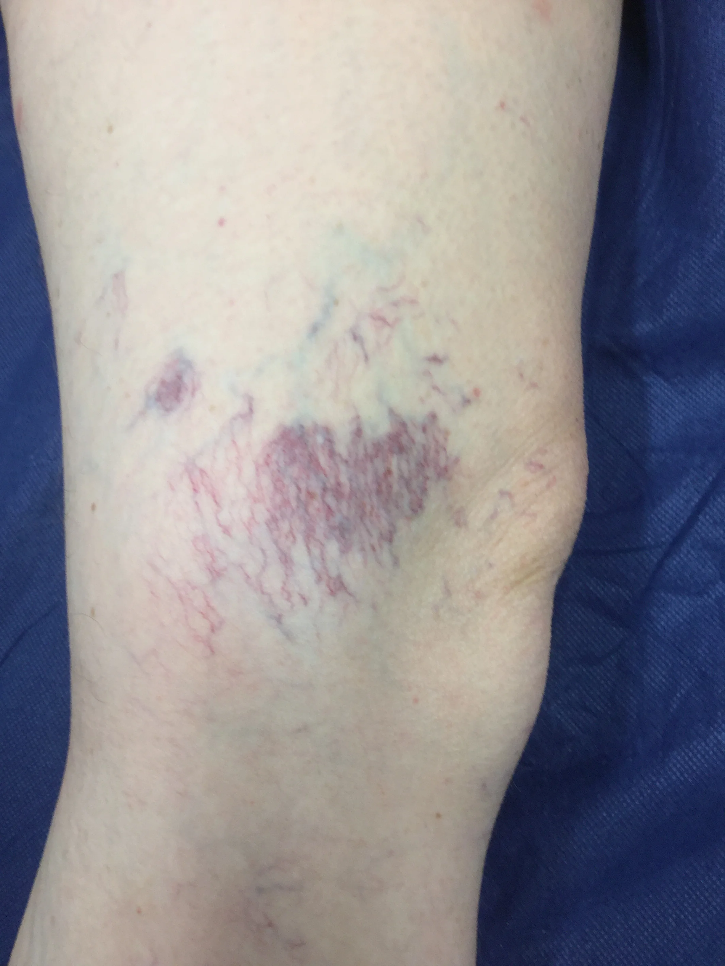 Venous Leg Ulcer — The Leg Vein Doctor Brisbane Varicose & Spider Vein ...