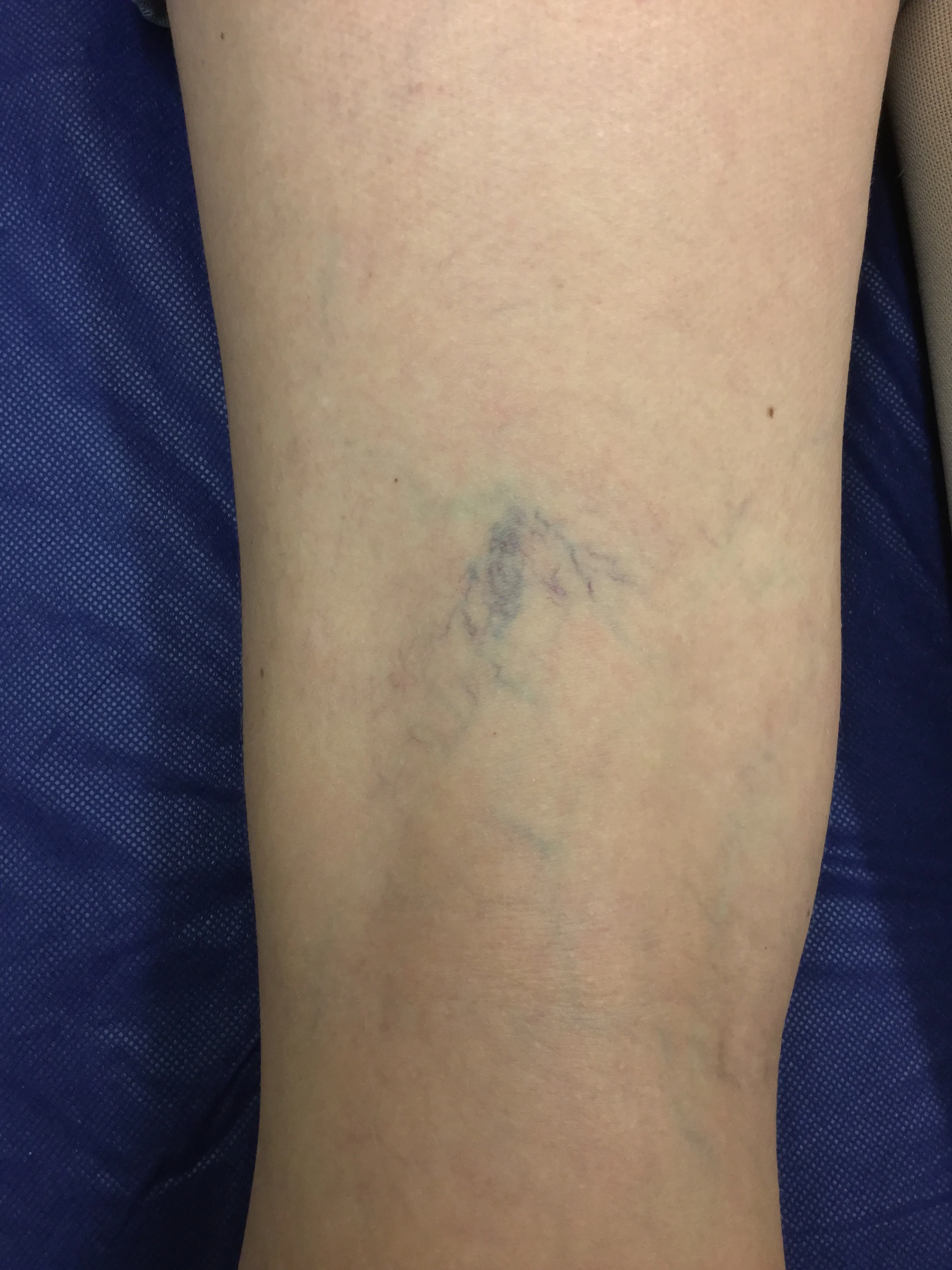 Venous Leg Ulcer — The Leg Vein Doctor Brisbane Varicose & Spider Vein ...