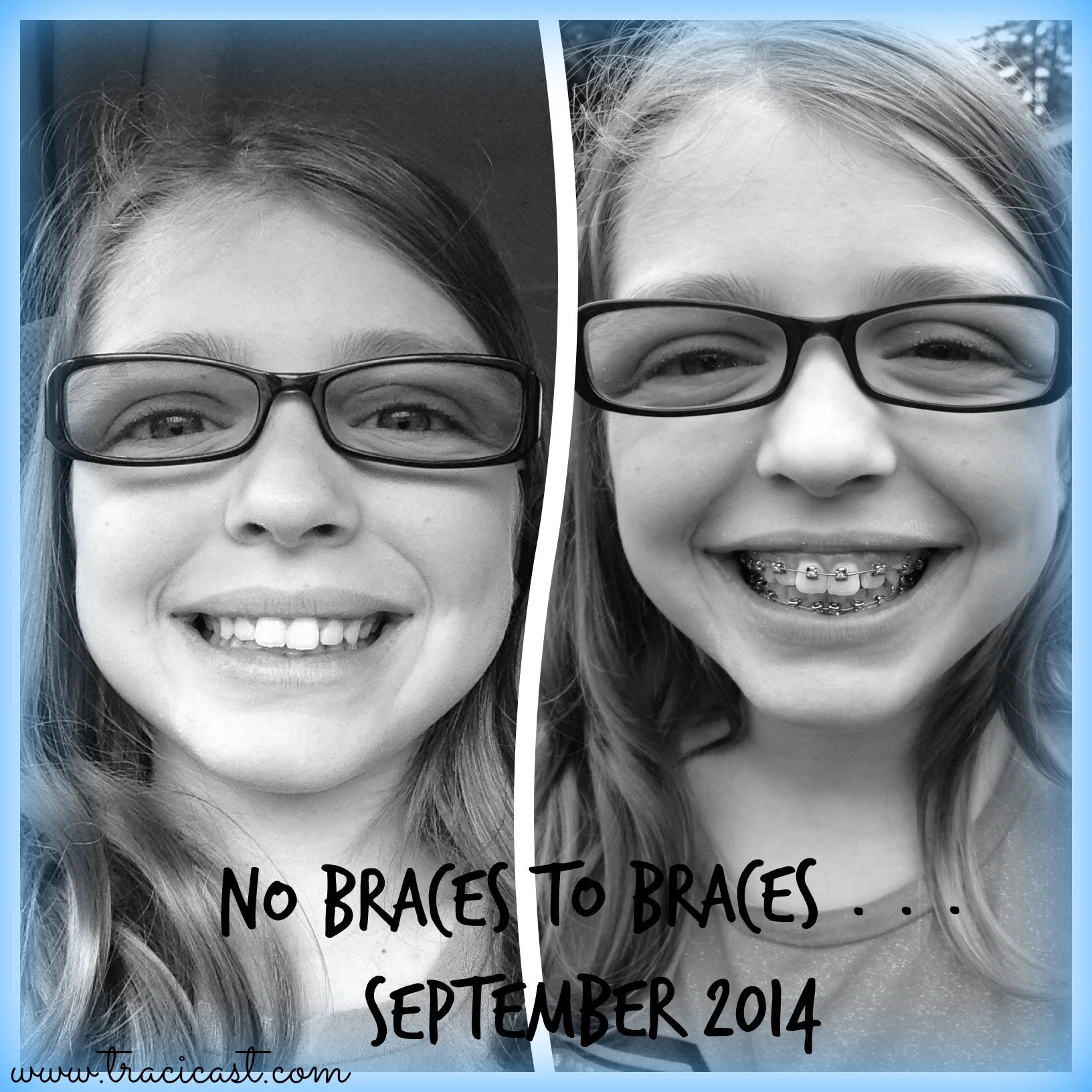People With And Without Braces Before And After