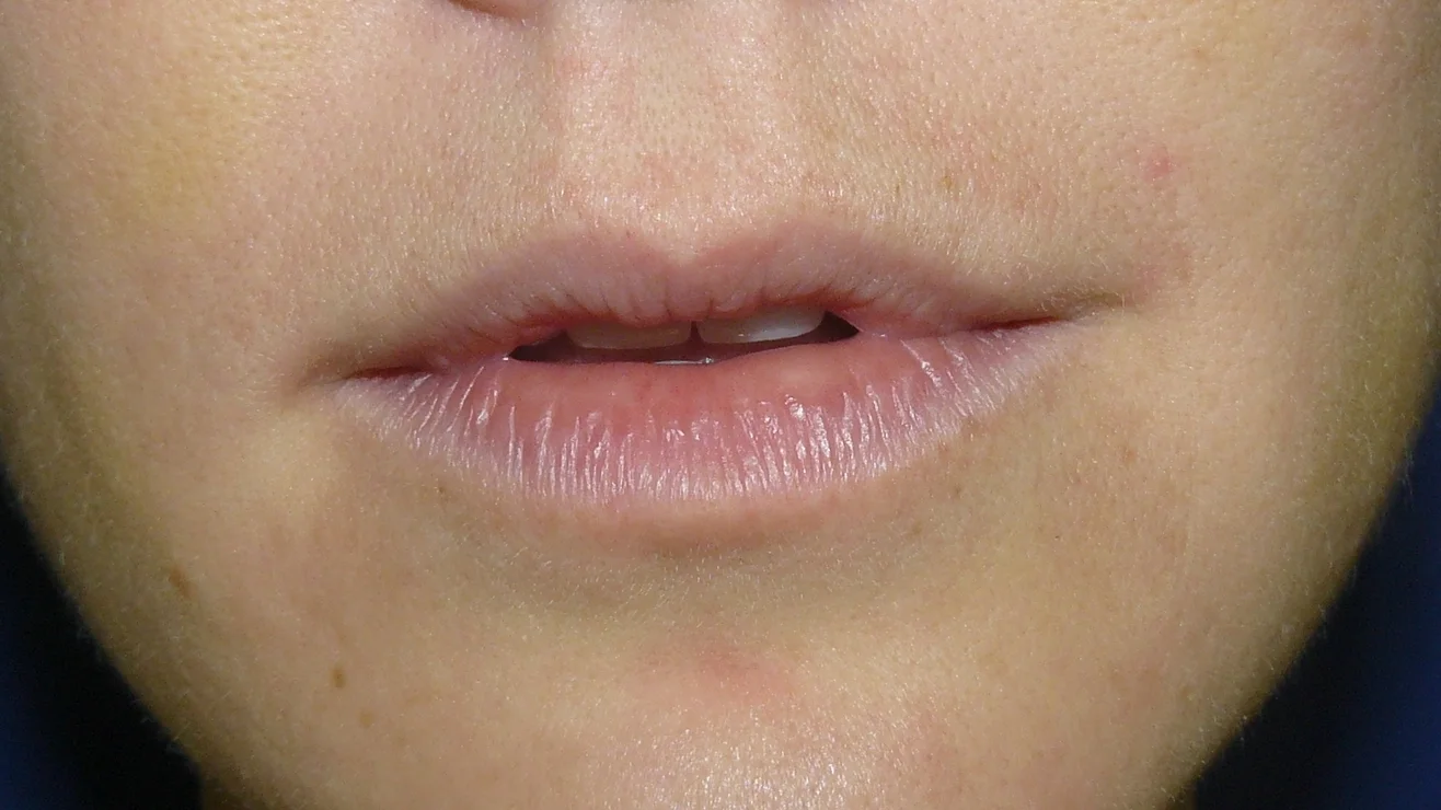 Perlane Lip Enhancement — Alan Fisher, MD