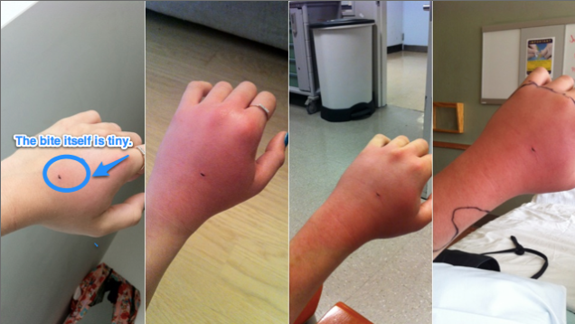 Cat Bite Wounds
