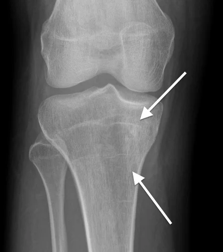 Sarcoma Case Studies — Sarcoma Specialists