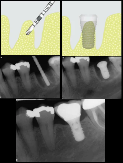 Immediate Implant Placement in Molar Sites — PeriOimplantology