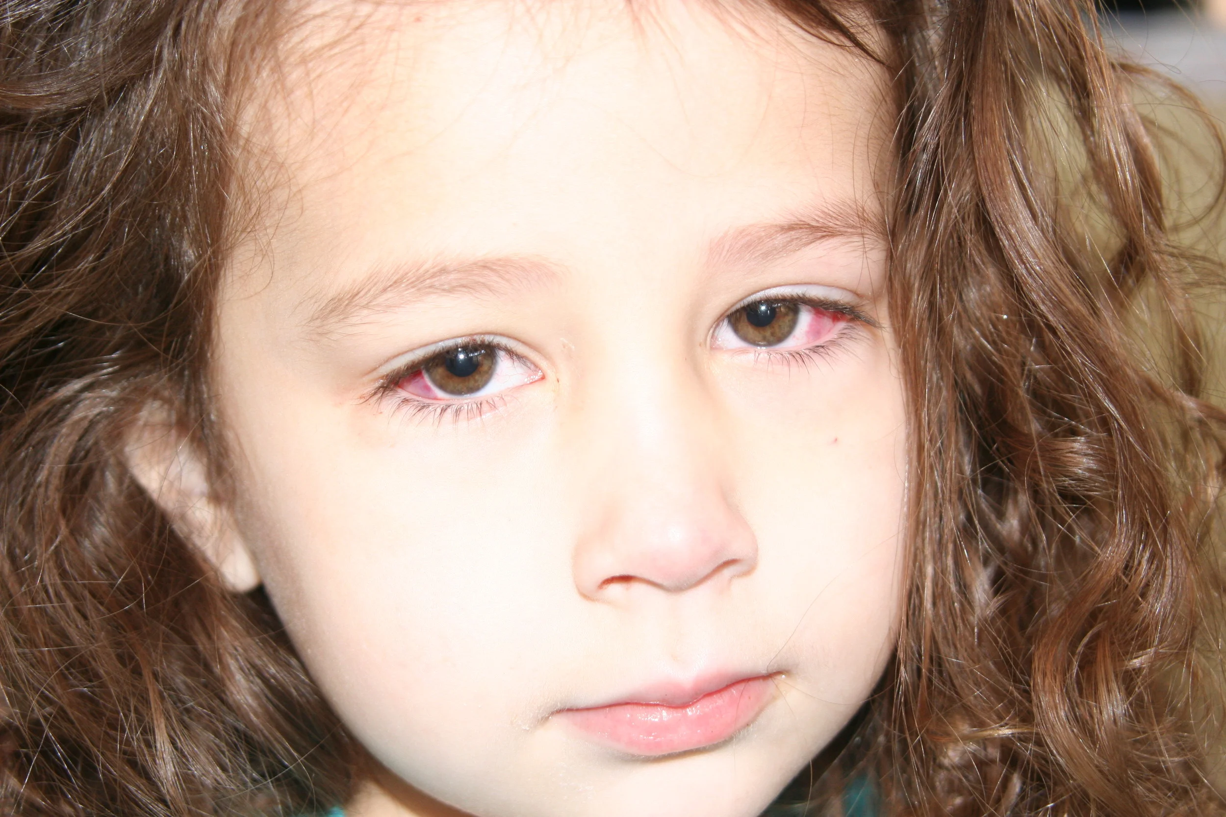 Bilateral Lateral Rectus Recession Surgery for Young Children — Tiaras ...