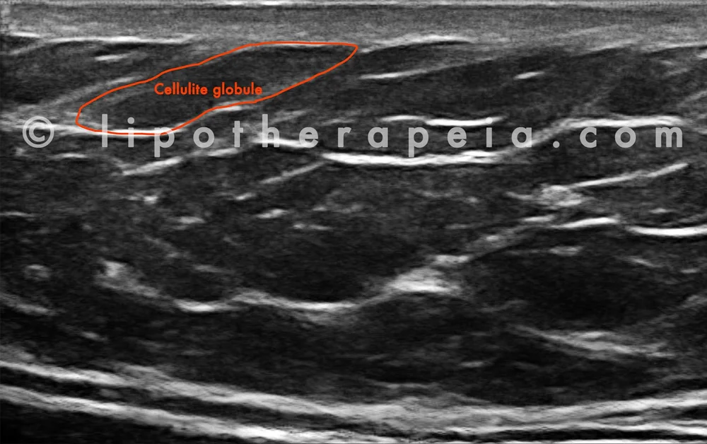 Advanced cellulite treatments in London | LipoTherapeia