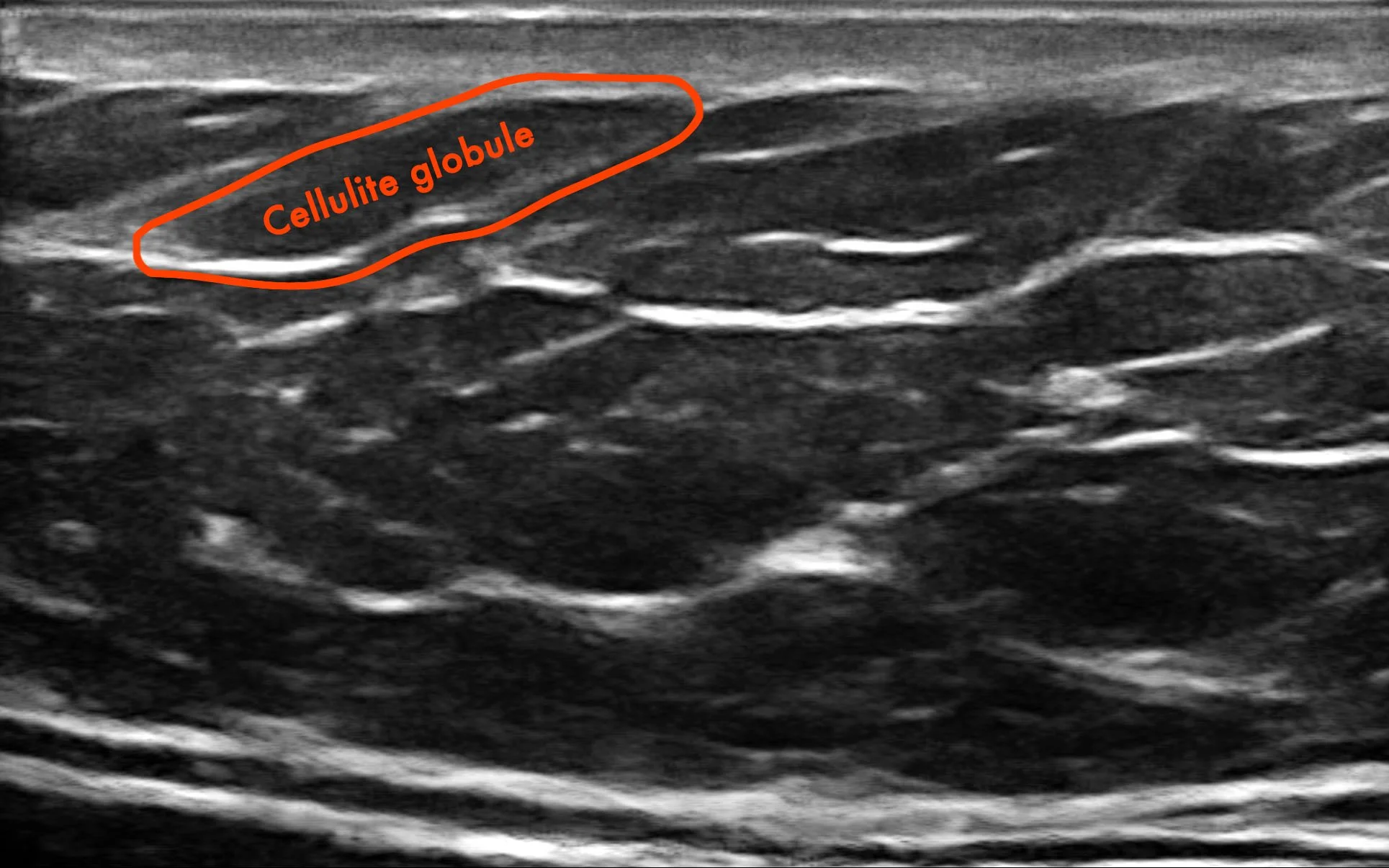 What is cellulite and how to reduce it - Advanced cellulite and skin ...