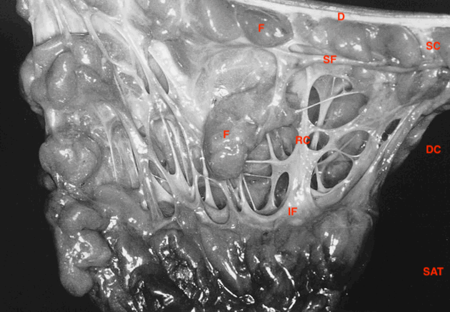 Fibrosis, cellulite and fibrous cellulite: what is the connection ...